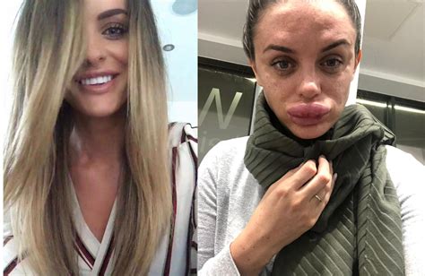 El peligroso retoque estético que causa la pérdida de los labios Fotos