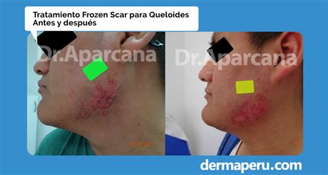 Tratamiento Para Queloides Frozen Scar Dermaperu