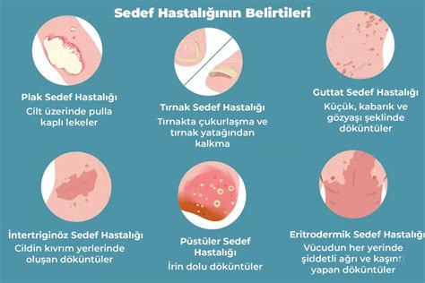 Sedef Hastalığı Psoriasis Nedir Belirtileri Nelerdir Doktor Fizik