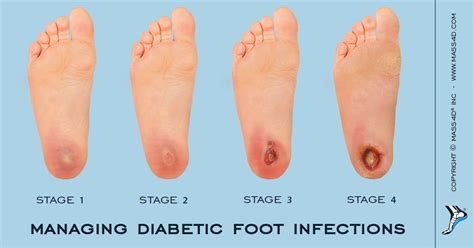 Diabetic Foot Ulcer Stage 1