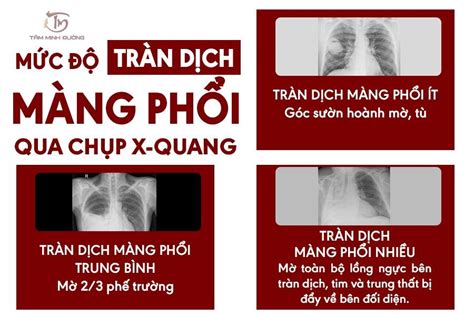 Tràn dịch màng phổi nguyên nhân triệu chứng và phác đồ điều trị an toàn