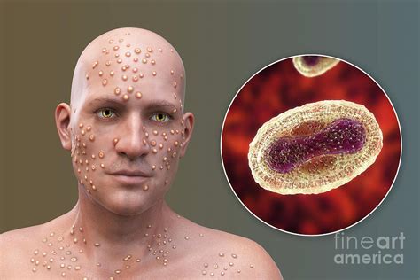 Smallpox Virus Infection 2 Photograph By Kateryna Kon Science Photo