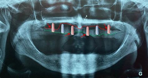 Implant Basal Techniques D Implantologie Basale La Solution Pour Vous