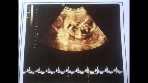 9 Tuần Mới Có Tim Thai Nguyên Nhân và Giải Pháp