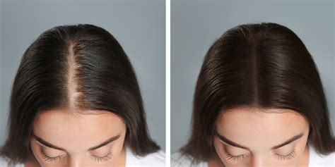 Caduta Dei Capelli Nelle Donne Cause E Rimedi Della Calvizie Femminile