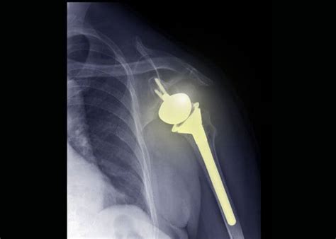 Reverse Shoulder Replacement Shoulder Surgeon Van Nuys Westlake