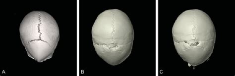 A 3 D Computed Tomography Reconstruction Of Patient 2 Demonstrating