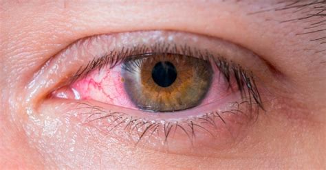 Conjuntivitis Bacteriana qué es síntomas y tratamiento Tua Saúde