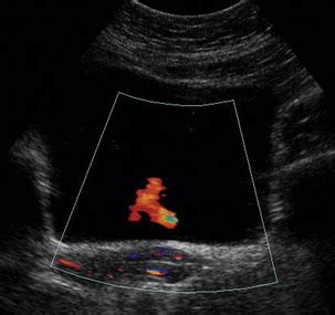 Doppler Ultrasound Of The Female Pelvis Radiology Key