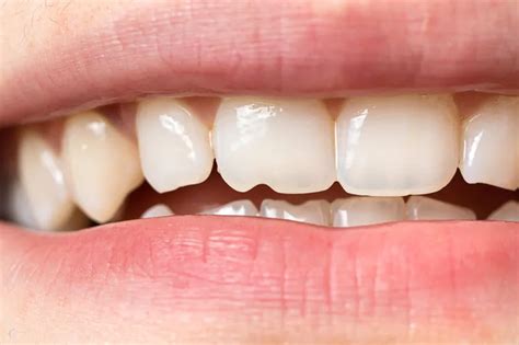 What Causes A Chipped Tooth And How Common Is This Dental Issue