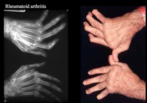 Rheumatology Flashcards Quizlet