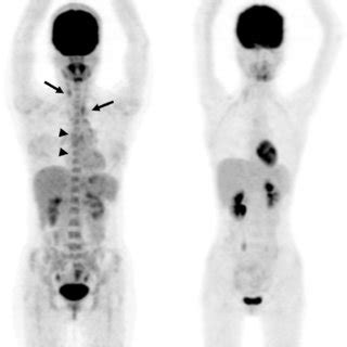 F 18 FDG PET CT Scan Of An 18 Year Old Woman Diagnosed With Takayasu