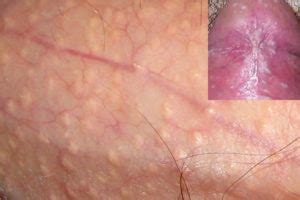 Las pápulas perladas son normales y no deben confundirse con el HPV