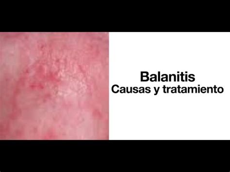 Balanitis Causas Síntomas Diagnóstico Y Tratamiento Doctor Online
