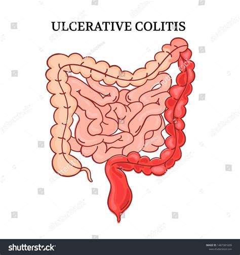 Ulcerative Colitis Intestines Medicine Anatomy Vector Vector có sẵn