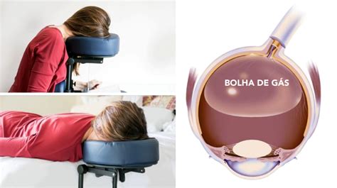 Cirurgia de Retina A Vitrectomia Clínica Roisman