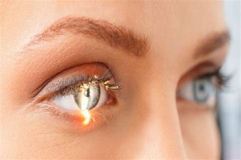 Benarkah Operasi Lasik Mata Gratis Intip Penjelasannya