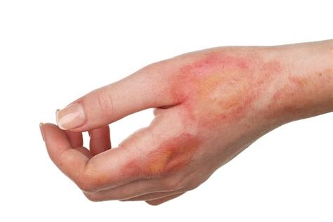 Pomadas para queimaduras 7 melhores opções e quando usar Brulure