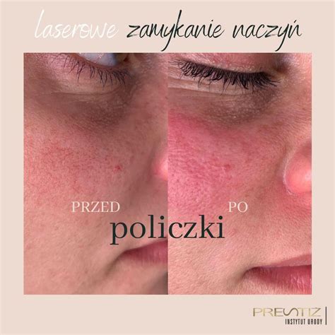 Laserowe zamykanie naczynek Prestiż Skin Clinic Prestiż Instytut Urody