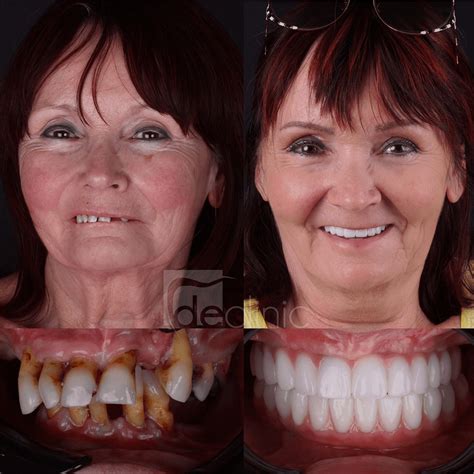 All On Six Implants Dental Excellence Turkey Dental Clinic In