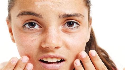 Ciltteki kahverengi lekeler nasıl geçer Cilt Bakımı