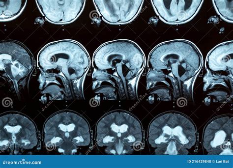 MRI Scan Or Magnetic Resonance Image Of Head And Brain Scan Stock Photo