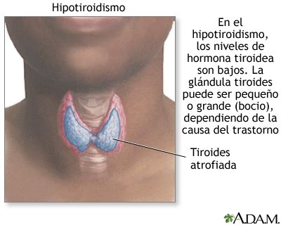 Hipotiroidismo MedlinePlus enciclopedia médica