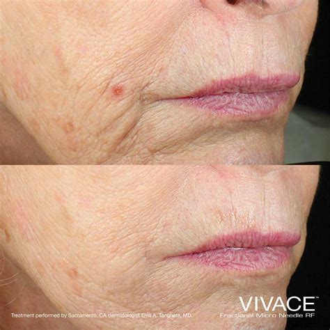 Fractional Rf Microneedling Vivace BBskin