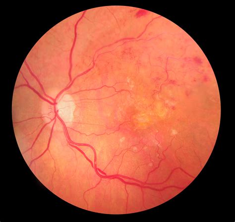 O Que O Descolamento De Retina Sa De Vitalidade