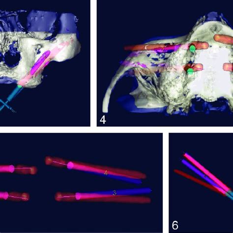 Preoperative And Postoperative Computed Tomography CT Scans In An