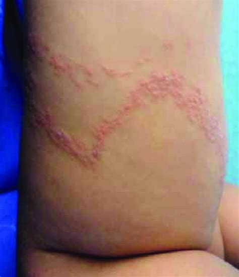 Dermatosis en tronco que sigue las líneas de Blaschko Download