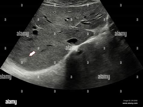 Ecografía del abdomen superior para el diagnóstico de dolor abdominal