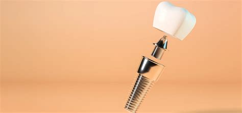 Cat Costa Un Implant Dentar Pret Gentle Dentist