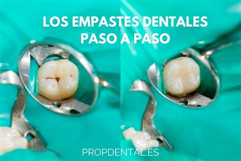 Empastar Una Muela Todo Lo Que Debes Saber Sobre El Tiempo Necesario
