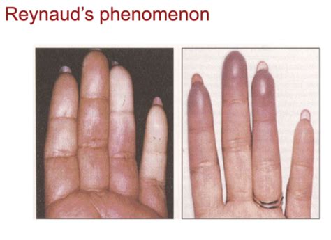 Peripheral Vascular Flashcards Quizlet