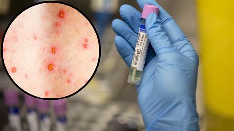 Viruela del mono o monkeypox en Sacramento el número de casos llega a