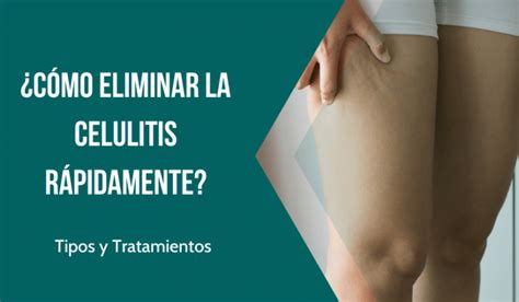 Qu Es La Celulitis Infecciosa Y Cmo Identificar