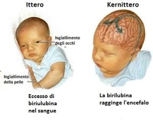 Ittero neonatale cause trattamento e come escludere problemi più seri