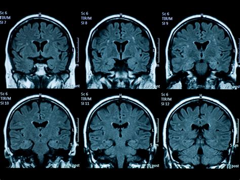 Cancer Drug Could Help Parkinsons Disease Sufferers The Independent