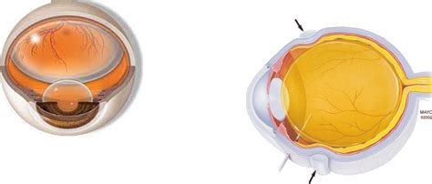 Cirurgia De Retina Vitrectomia Dr Leonardo Eloy Sousa