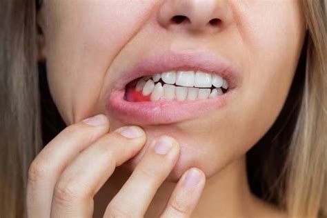 Piorrea qué es Causas Síntomas y Tratamiento