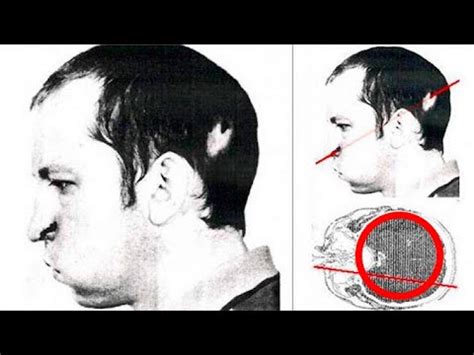 A Incrível História do Homem que Sobreviveu a um Acelerador de