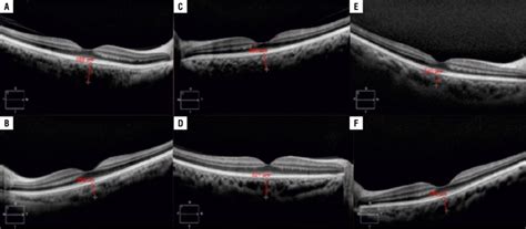 Representative Cases Of Enhanced Depth Imaging Spectral Domain Optical
