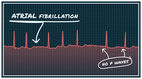 What Atrial Fibrillation Afib Looks Like On Your Watch ECG Qaly