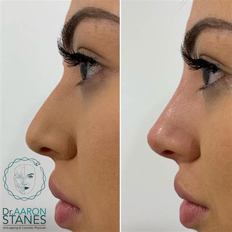 Non Surgical Rhinoplasty Nose Fillers Nonsurgical Nose Job Nose Job