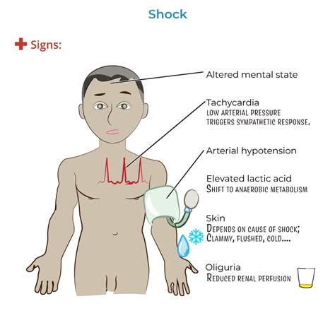 USMLE COMLEX Step 2 Glossary Shock For USMLE Step 2 Ditki