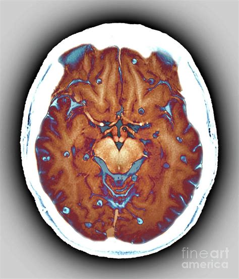 Cysticercosis Of The Brain Photograph By Zephyr Science Photo Library