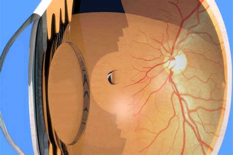 Retinal Tear Retinal Detachment Symptoms Causes Treatment