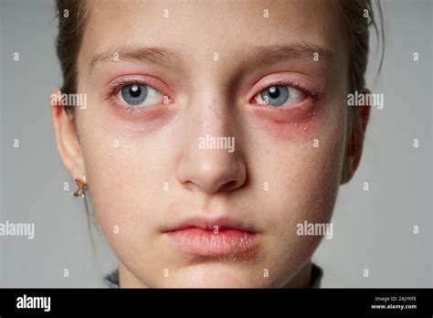 Allergic Reaction Skin Rash Close View Portrait Of A Girls Face Redness And Inflammation Of