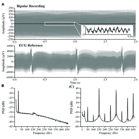 ecg artifact removal without extra filtering of dbs artifacts a download scientific